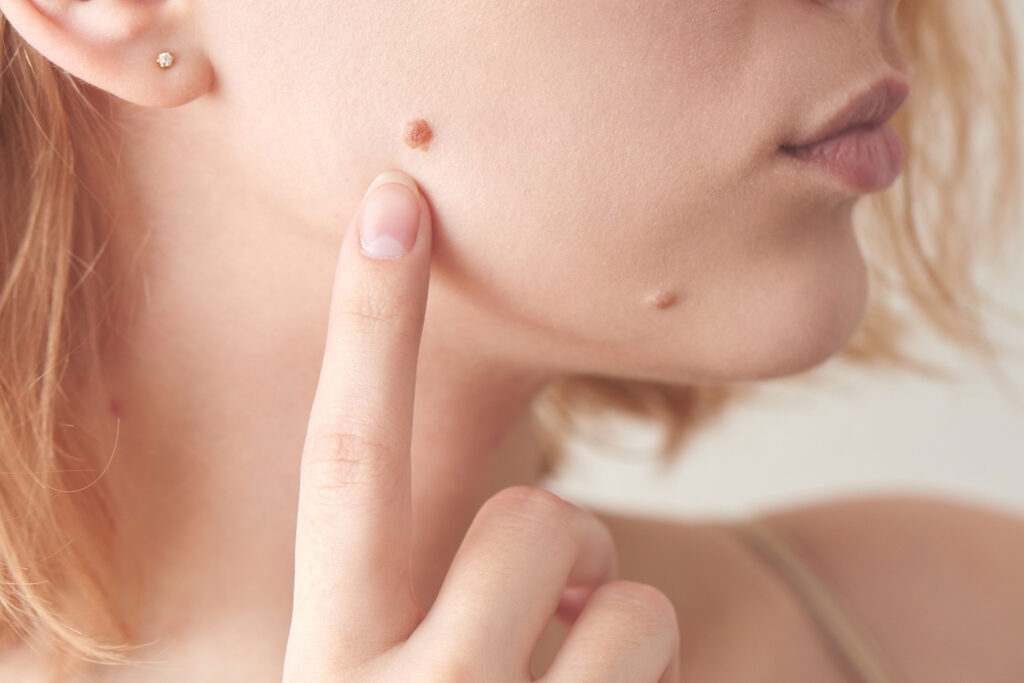 What Are Skin Tags and Safe Ways to Get Rid of Them